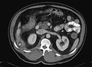 Absceso perihepático secundario a cálculo biliar olvidado en cavidad ...