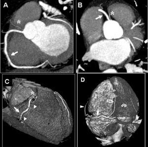 Anatomía normal, variantes anatómicas y anomalías del origen y trayecto ...