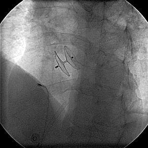 Foramen oval permeable: situación actual | Revista Española de Cardiología