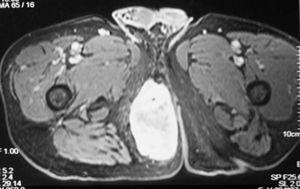 Angiomixoma agresivo pelviperineal en el varón | Cirugía Española