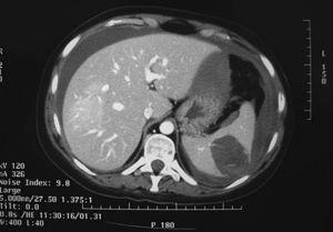 Hemoperitoneo espontáneo por hemangiosarcoma de bazo | Cirugía Española