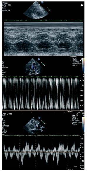 Transient Cardiac Constriction With Severe Heart Failure | Revista ...