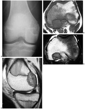 Manifestaciones radiológicas del condroblastoma | Radiología