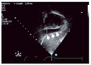Morgagni-Larrey Hernia: A Rare Cause of Pericardial Effusion | Revista ...