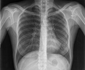 Tuberculosis miliar en paciente inmunocompetente. A propósito de un ...