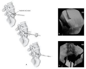 Colocación de una prótesis de disco intervertebral lumbar Prodisk ...