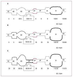 La circulación pulmonar en la insuficiencia cardiaca | Revista Española ...