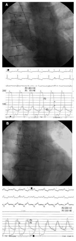 Percutaneous Aortic CoreValve Prosthesis in a Degenerated Bioprosthesis ...