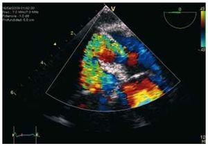 Patent Foramen Ovale and Mechanical Ventilation | Revista Española de ...