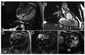 Tissue Characterization of a Primary Cardiac Angiosarcoma Using ...