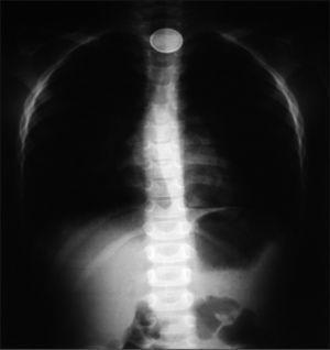 Pila de botón en esófago | Acta Otorrinolaringológica Española