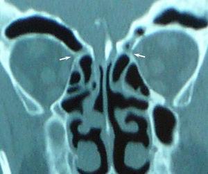 La arteria etmoidal anterior en el laberinto etmoidal: Revisión ...