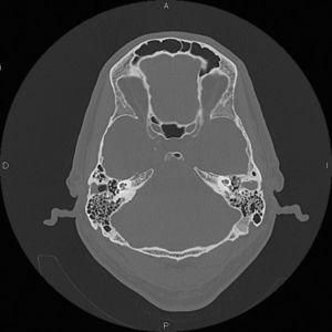 Otitis externa maligna. Nuestra experiencia | Acta ...