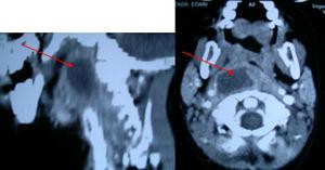 Infecciones cervicales profundas. Revisión de 286 casos | Acta ...
