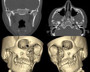 Cóndilo mandibular bífido bilateral | Acta Otorrinolaringológica Española
