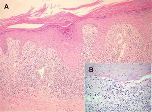 Blaschkitis del adulto (liquen estriado) tratado de forma exitosa con ...
