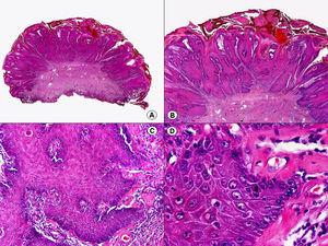 Histopatología de las infecciones víricas cutáneas más frecuentes ...