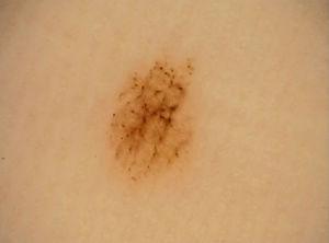 Dermoscopic Patterns of 158 Acral Melanocytic Nevi in a Latin American ...