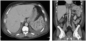 Abscesos esplénicos múltiples | Cirugía Española