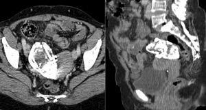 Litopedion | Cirugía Española
