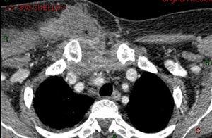 Absceso mamario y sepsis con origen en infección oral | Cirugía Española