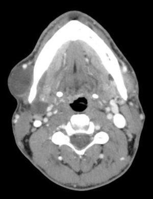 Utilidad del tratamiento conservador en el linfangioma quístico ...