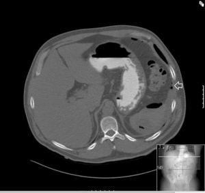 Neumoperitoneo por absceso esplénico: un reto diagnóstico. Reporte de ...