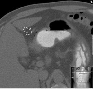 Neumoperitoneo por absceso esplénico: un reto diagnóstico. Reporte de ...