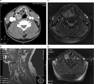 Solución del caso 32. Leiomioma del seno piriforme diagnosticado por ...