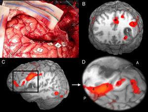 Mapa cortical y subcortical del lenguaje. Correlación de la resonancia magnética funcional y ...