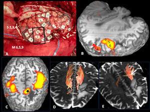 Mapa cortical y subcortical del lenguaje. Correlación de la resonancia magnética funcional y ...