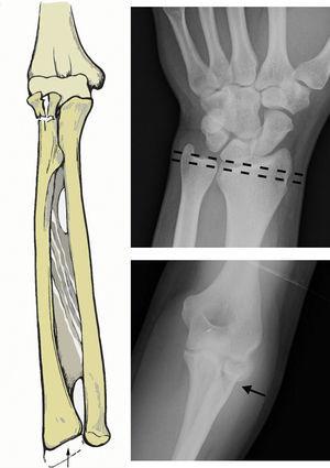 Radiología de las fracturas: algo más que un trazo | Radiología