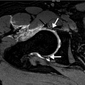 Diagnóstico de lesiones del labrum acetabular, de la unión condrolabral ...