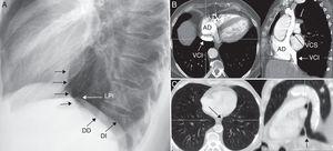 Radiografía lateral de tórax. Anatomía radiográfica | Radiología