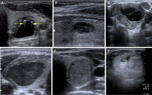 Valor actual de la ecografía en la caracterización de los nódulos ...