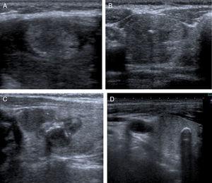 Valor actual de la ecografía en la caracterización de los nódulos ...