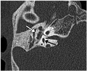 Malformaciones del oído interno: una aproximación diagnóstica práctica ...