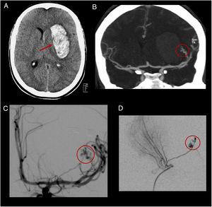 Utilidad de la angio-TC para la caracterización de malformaciones ...