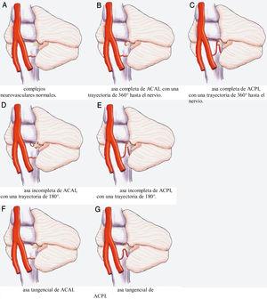 Correlación clínico-radiológica del asa vascular del ángulo ...
