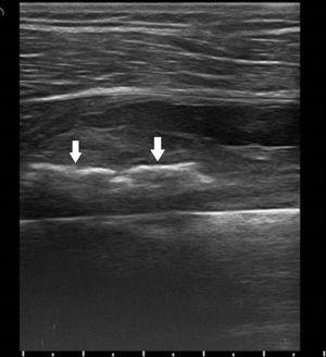 RM en miositis osificante traumática en fase aguda | Revista Argentina ...