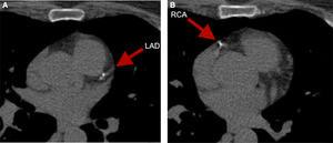 Utility of coronary calcium score in women | Revista Colombiana de ...