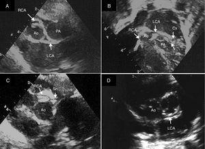 Double artery transposition: Coronary pattern and great arteries ...