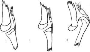 Luxación congénita de rodilla bilateral. Reporte de caso | Revista ...