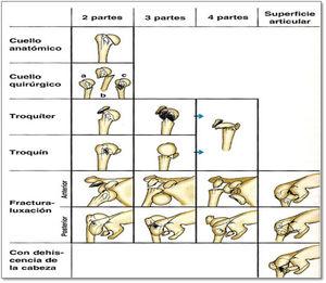 Clasificación de Neer. Variabilidad interobservador | Revista ...