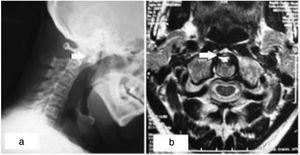 Atlantoaxial subluxation revealing rheumatoid arthritis. Case report ...