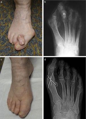 Use of 1st metatarsophalangeal joint fusion for repair of geriatric ...