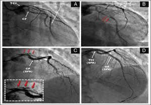 Disección coronaria espontánea, e idiopática, del tronco coronario ...