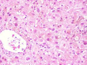 Colestasis intrahepática grave asociada a la ingesta de cetiricina ...