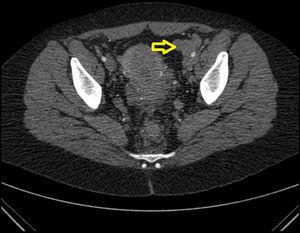 Rectorragia como síntoma de presentación de una agenesia de cava ...