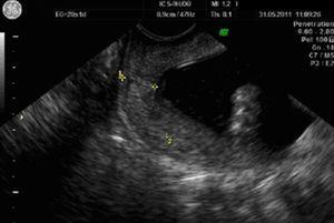 Sludge amniótico como marcador ecográfico en una gestación gemelar con ...